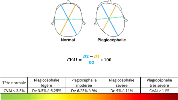 Le diagnostic de la plagiocéphalie - Chabloz plagiocéphalie